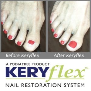 KeryFlex Cosmetic Nail Restoration in Lorain and Elyria, OH
